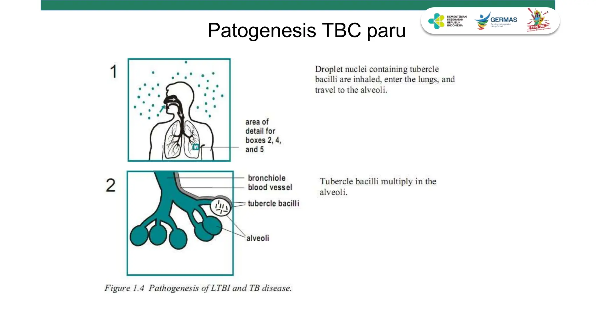 Modul 4B Diagnosis TBC pada Dewasa OK.pptx