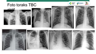 Modul 4B Diagnosis TBC pada Dewasa OK.pptx