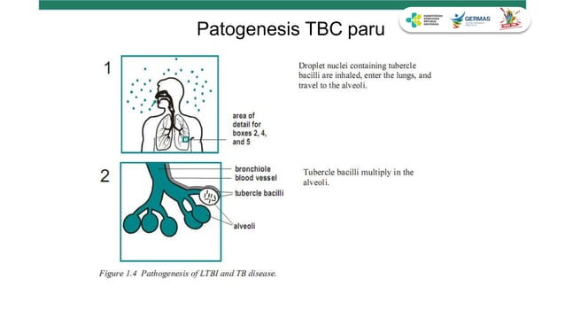 Modul 4B Diagnosis TBC pada Dewasa OK.pptx