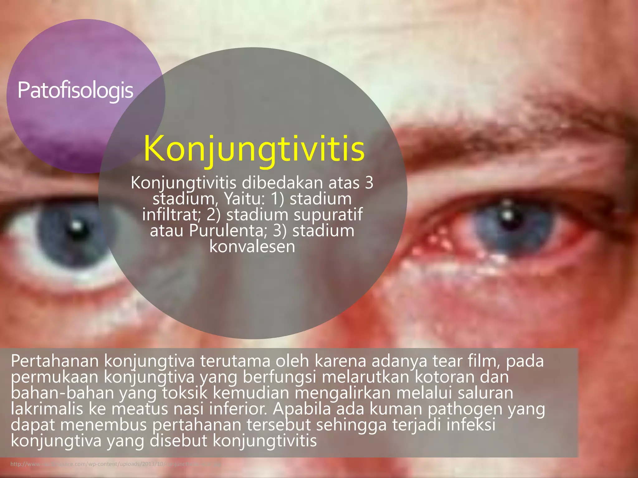 Asuhan Keperawatan Pada Pasien Dengan Peradangan Pada Mata (Konjungtivitis) | PPTX