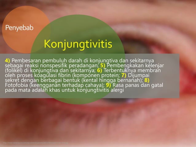 Asuhan Keperawatan Pada Pasien Dengan Peradangan Pada Mata (Konjungtivitis) | PPTX