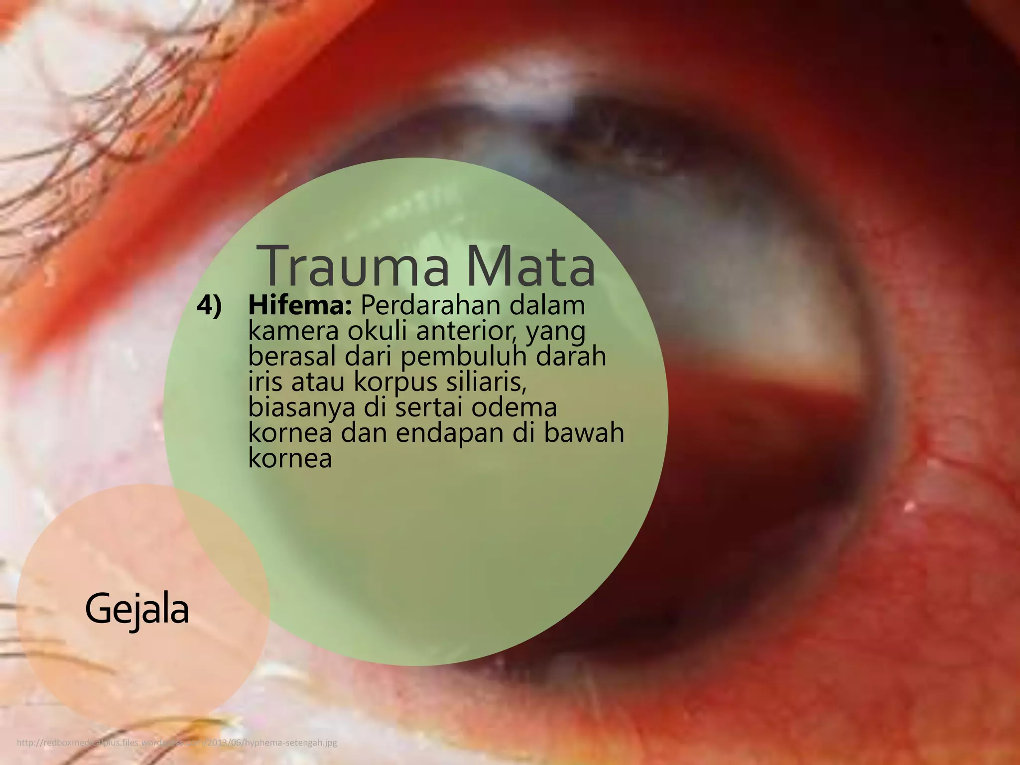 Asuhan Keperawatan Pada Pasien Dengan Trauma Mata | PPTX