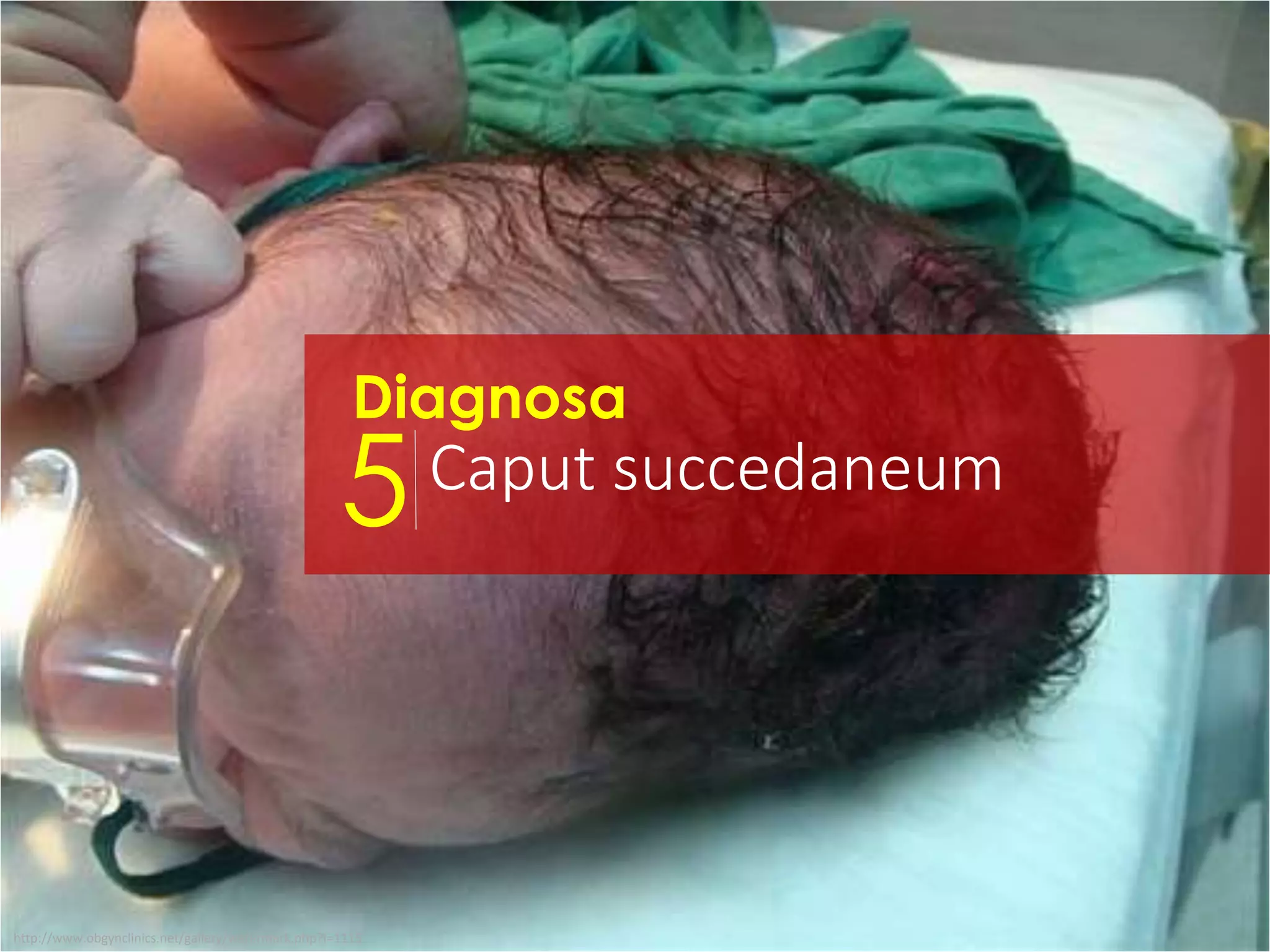 Modul 5 kb 1 asuhan neonatus dan bayi dengan caput succedaneum | PPTX