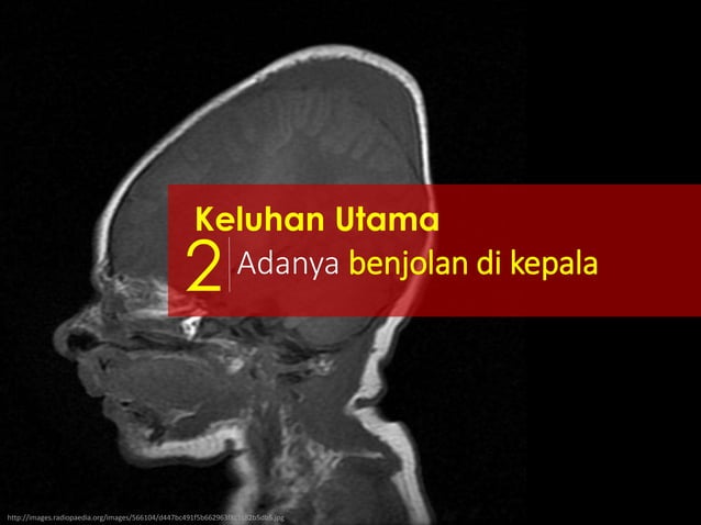 Modul 5 kb 1 asuhan neonatus dan bayi dengan caput succedaneum | PPTX