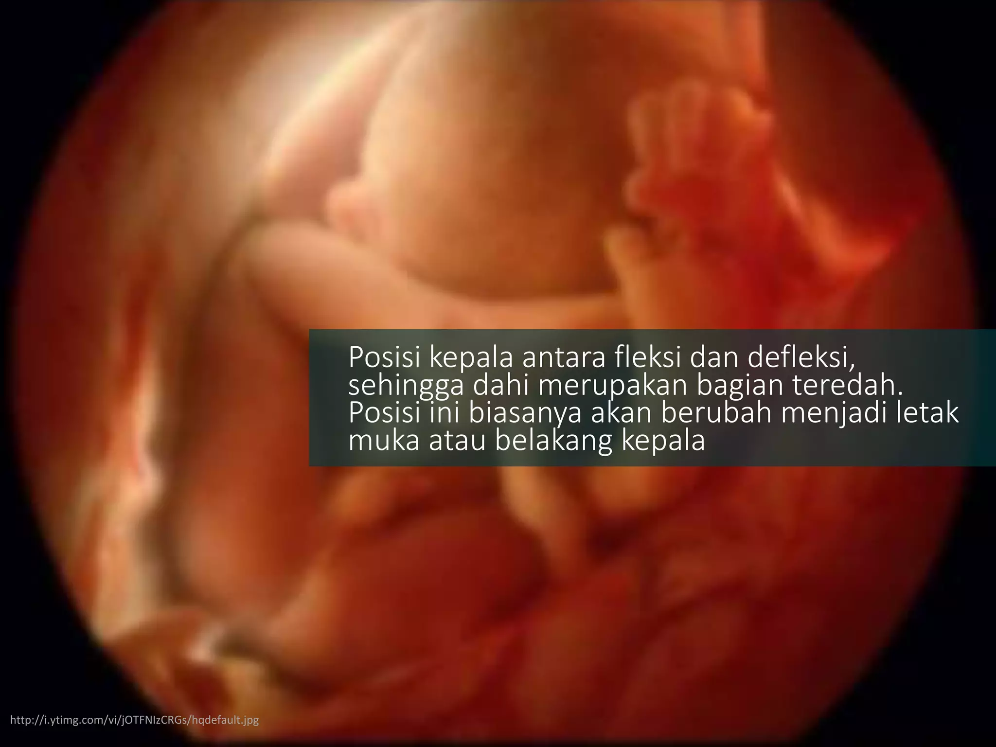 Modul 5 kb 1 penyulit komplikasi persalinan kala i dan ii persalinan | PPTX