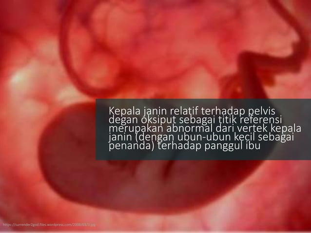 Modul 5 kb 1 penyulit komplikasi persalinan kala i dan ii persalinan | PPTX