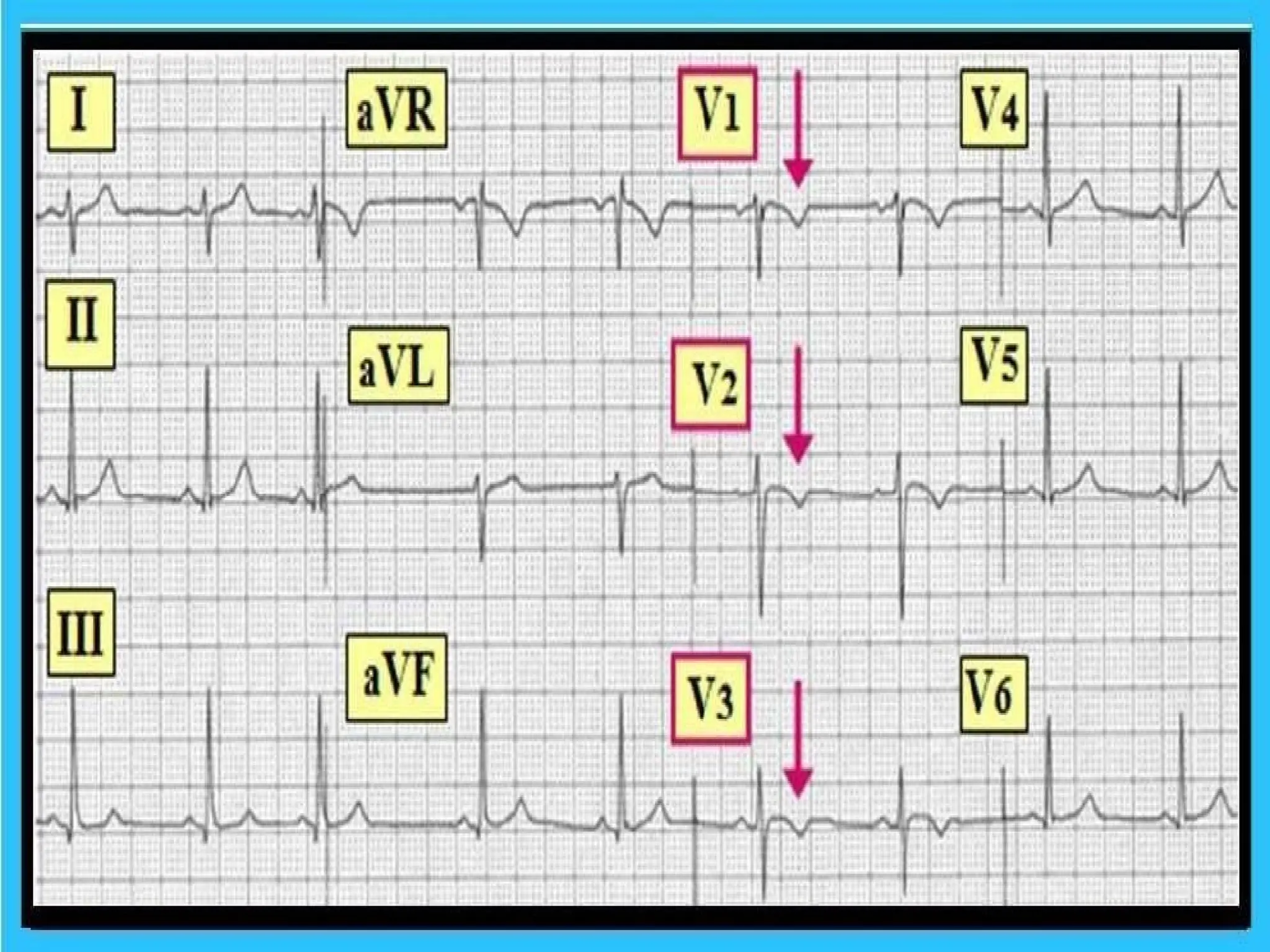 Modul Cara Praktis Membaca EKG untuk perawat dan nakes lain.pptx