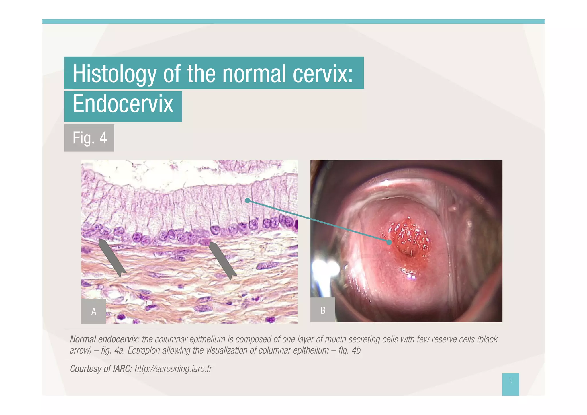anatomy of transformation zone.pdf | Reproductive Health | Diseases and ...