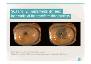 anatomy of transformation zone.pdf