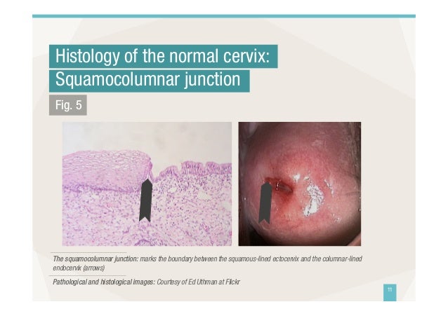anatomy of transformation zone.pdf