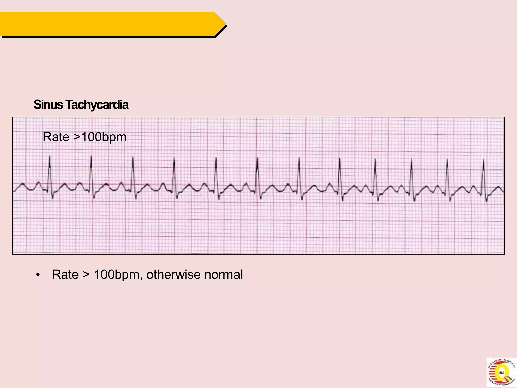 Module 2 interpreting ecg rythm strips-1-converted | PPTX