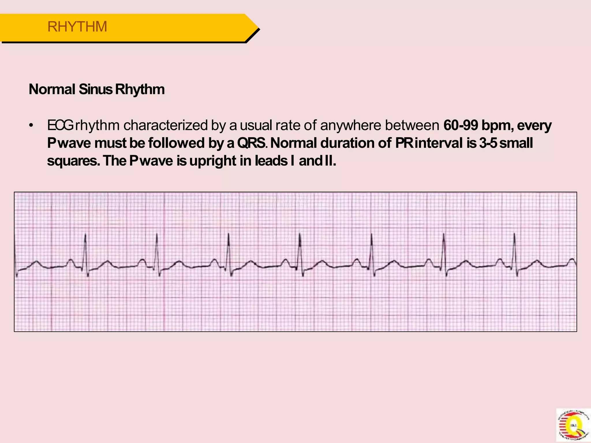 Module 2 interpreting ecg rythm strips-1-converted | PPTX