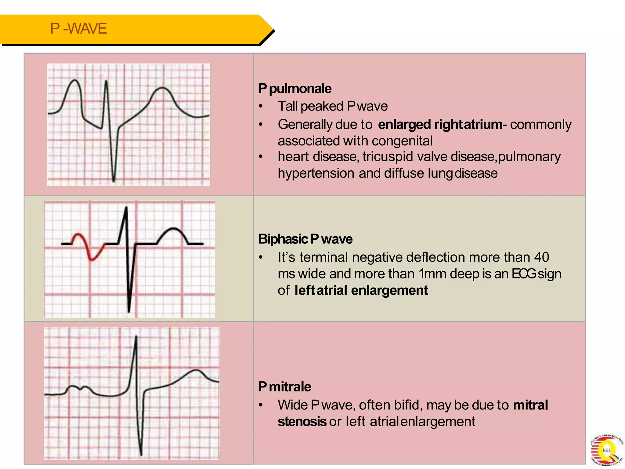 Module 2 interpreting ecg rythm strips-1-converted | PPTX