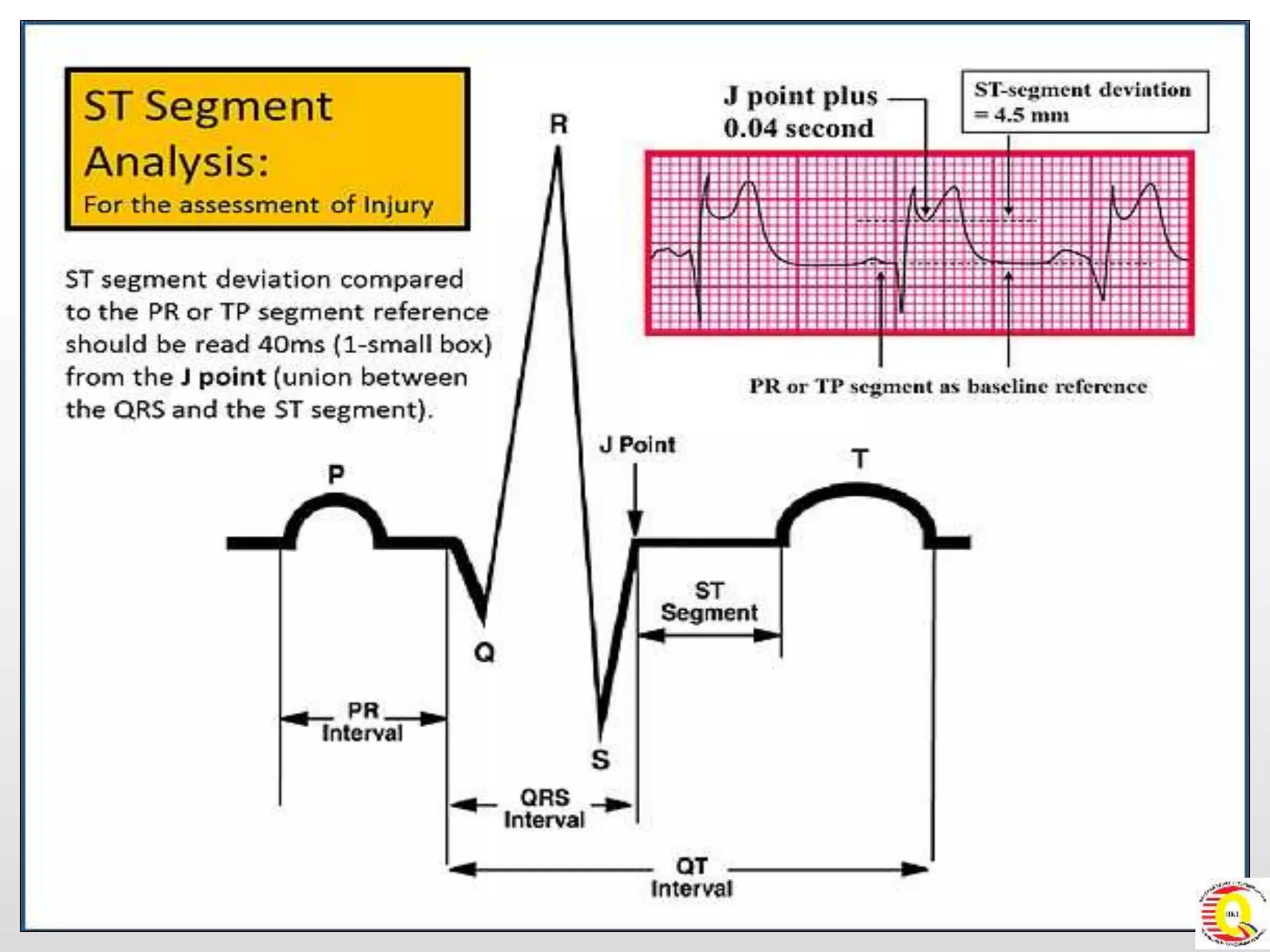 Module 2 interpreting ecg rythm strips-1-converted | PPTX