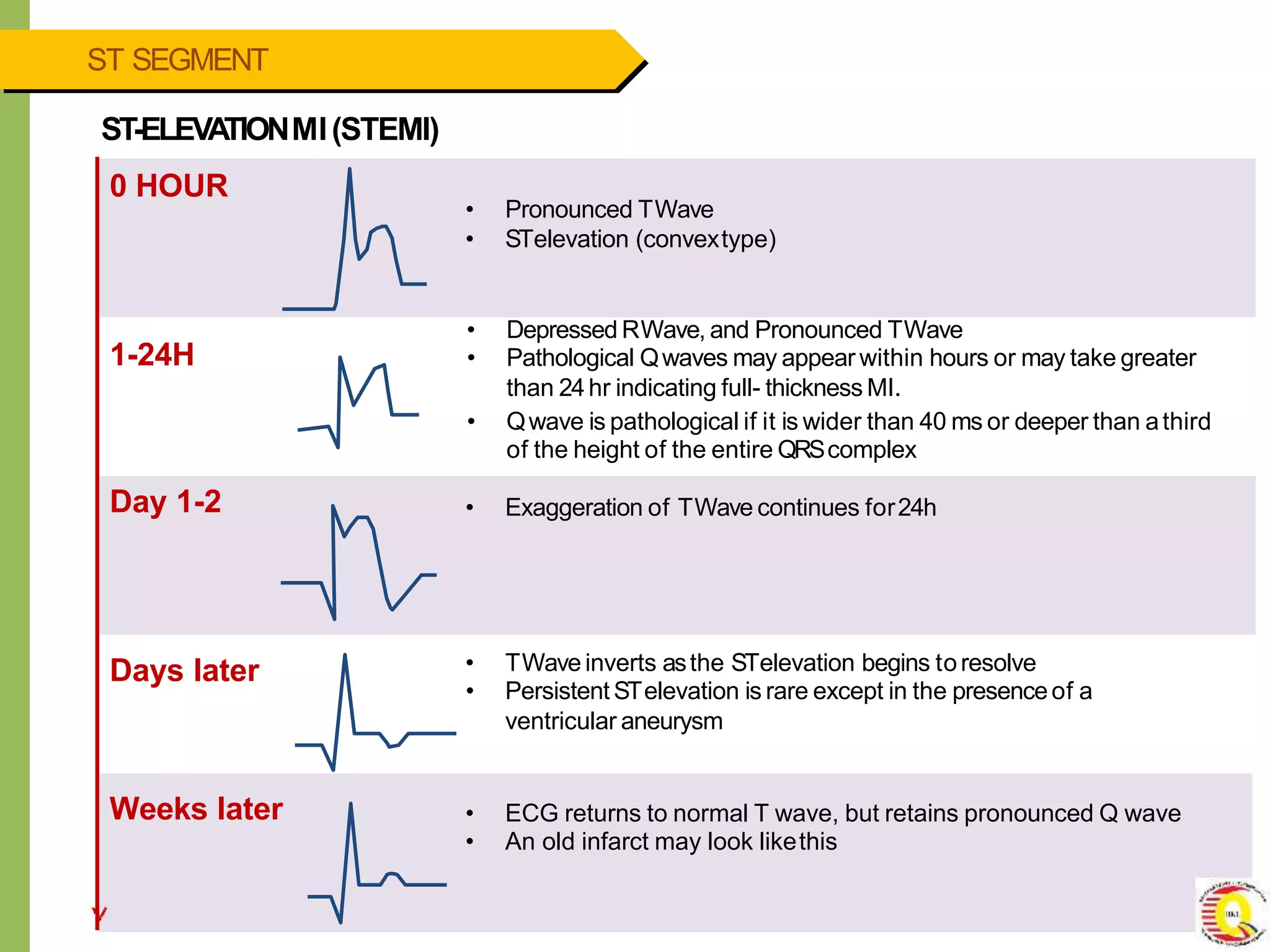 Module 2 interpreting ecg rythm strips-1-converted | PPTX