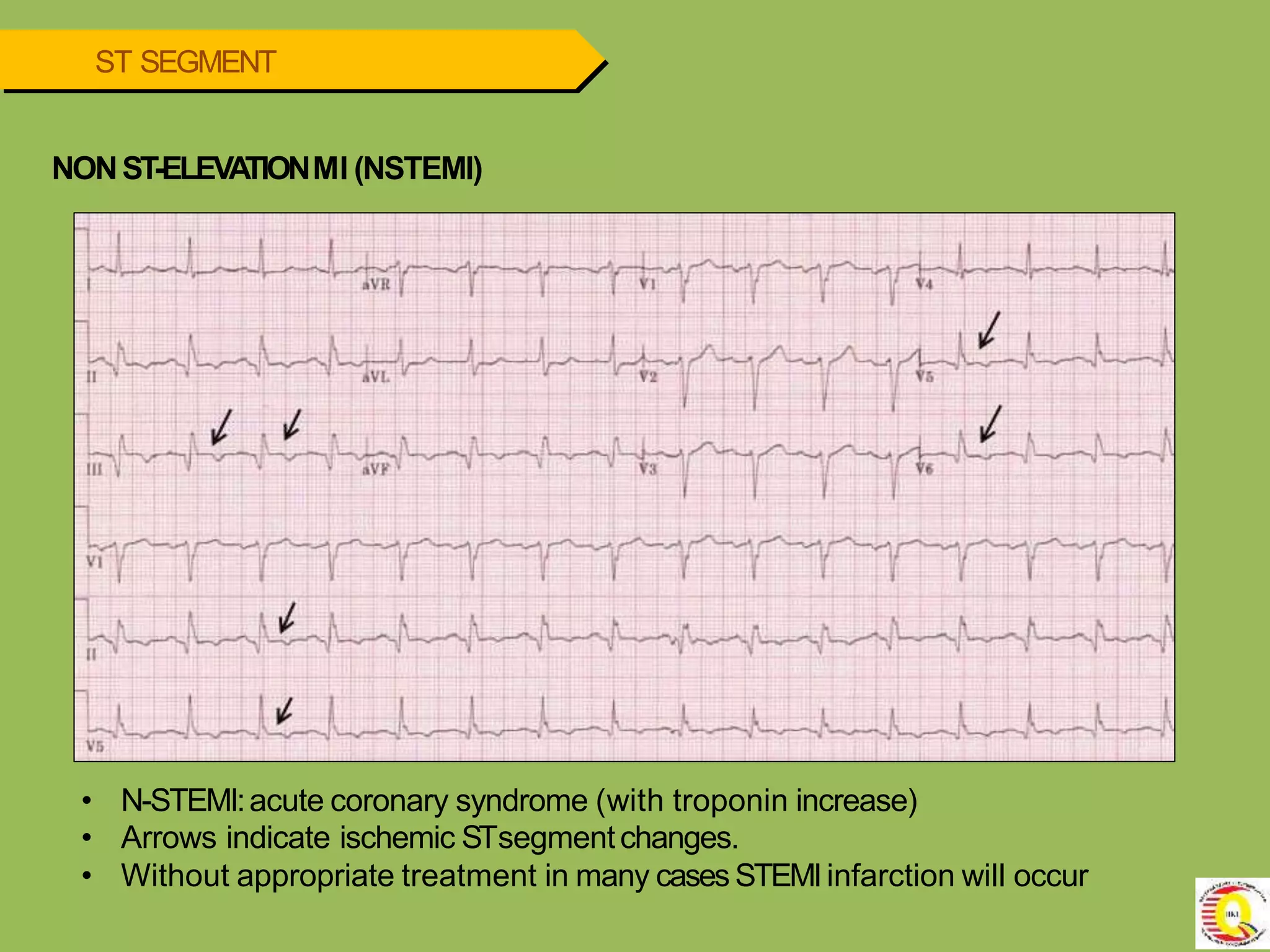 Module 2 interpreting ecg rythm strips-1-converted | PPTX