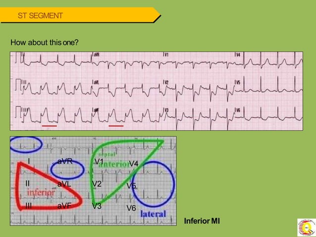 Module 2 interpreting ecg rythm strips-1-converted | PPTX