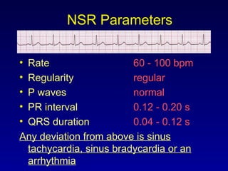 Normal Sinus Rhythem | PPT