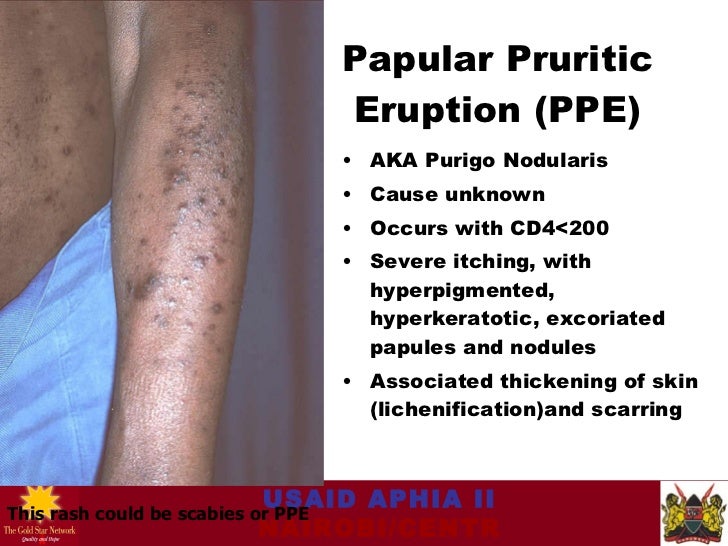 Module 3 opportunistic infections and hiv related conditi