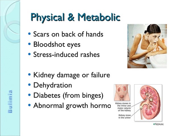 Medical Complications associated with Eating Disorders | PPT