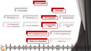 Module 4 av block and bradyarrythmias-1 | PPTX