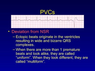 ECG PART 4 | PPT