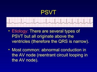 ECG PART 5 | PPT