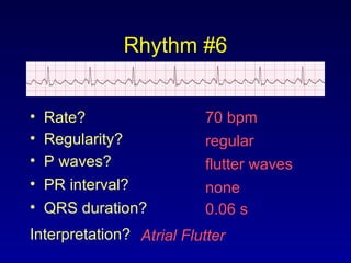 ECG PART 5 | PPT