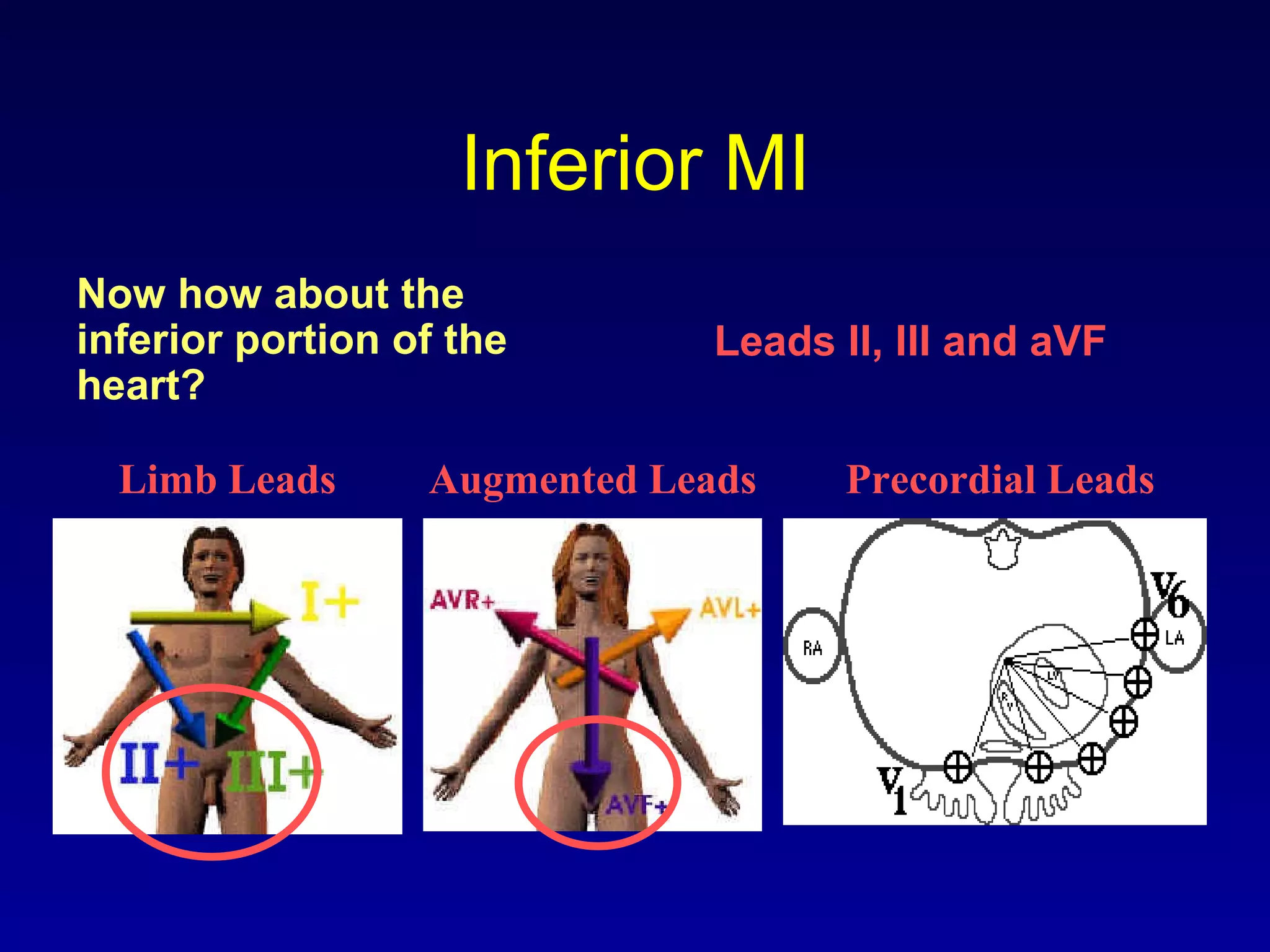 ECG Infarction | PPT