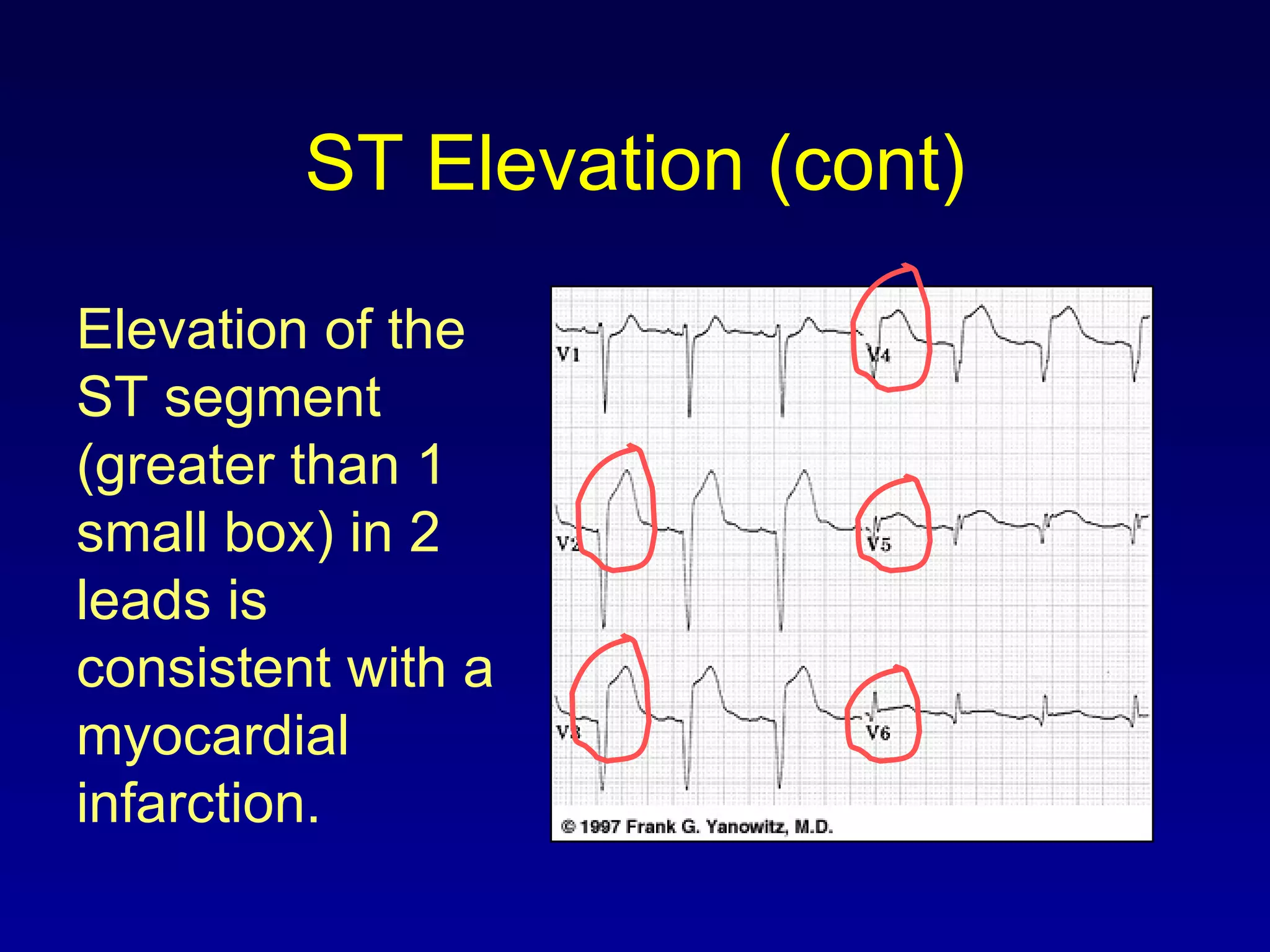 ECG Infarction | PPT