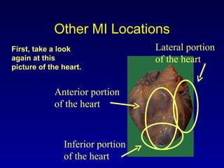 ECG Infarction | PPT