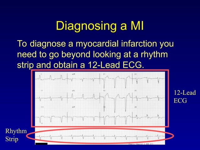 Module on ecg rhythm interpretation management | PPT