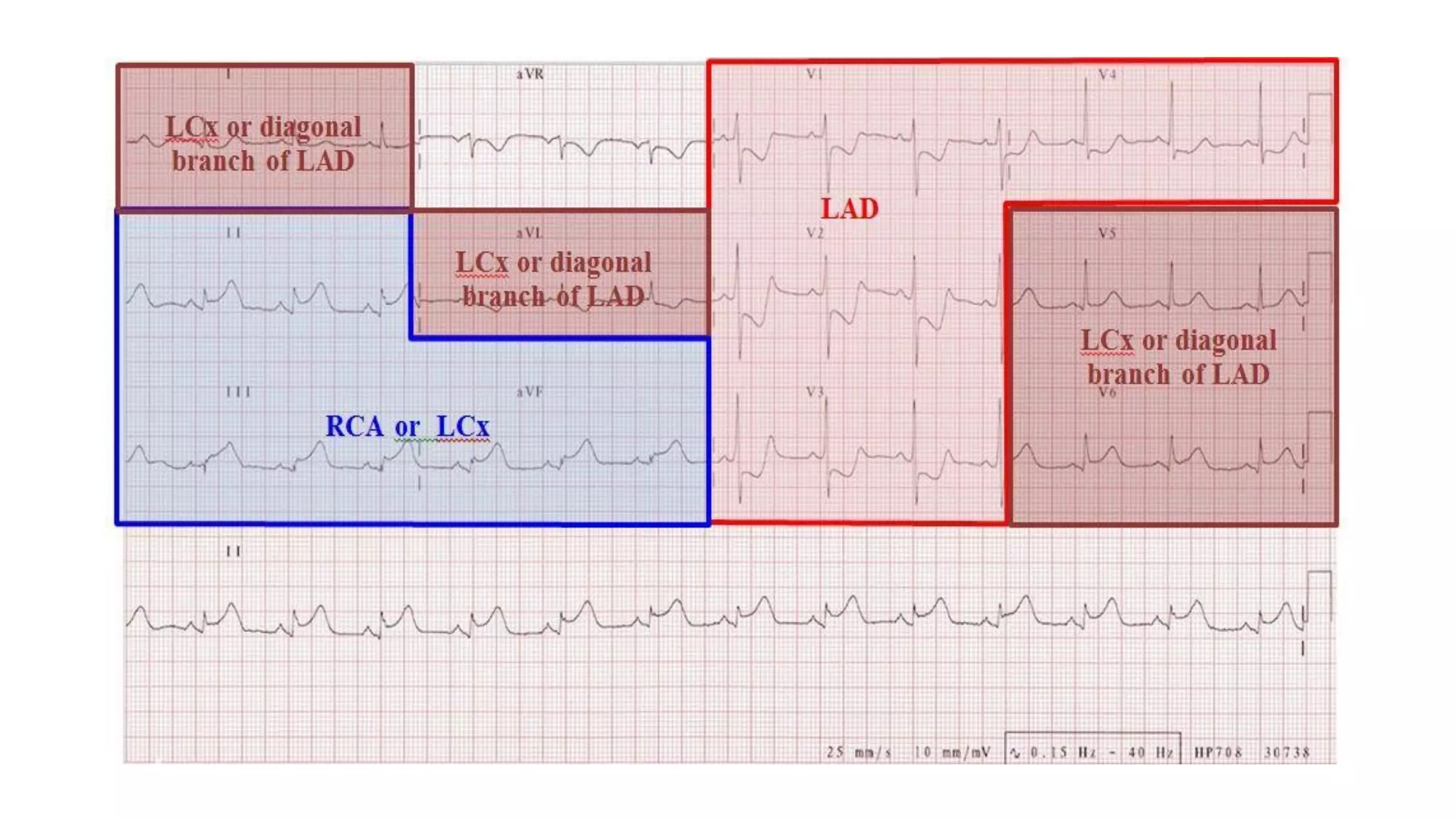 Module 5 tips and tricks- stemi ecg recognition & patterns finale | PDF