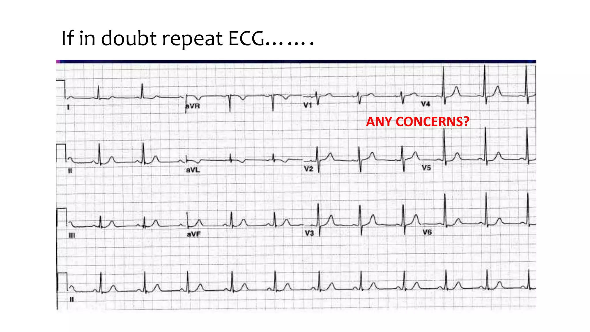 Module 5 tips and tricks- stemi ecg recognition & patterns finale | PDF