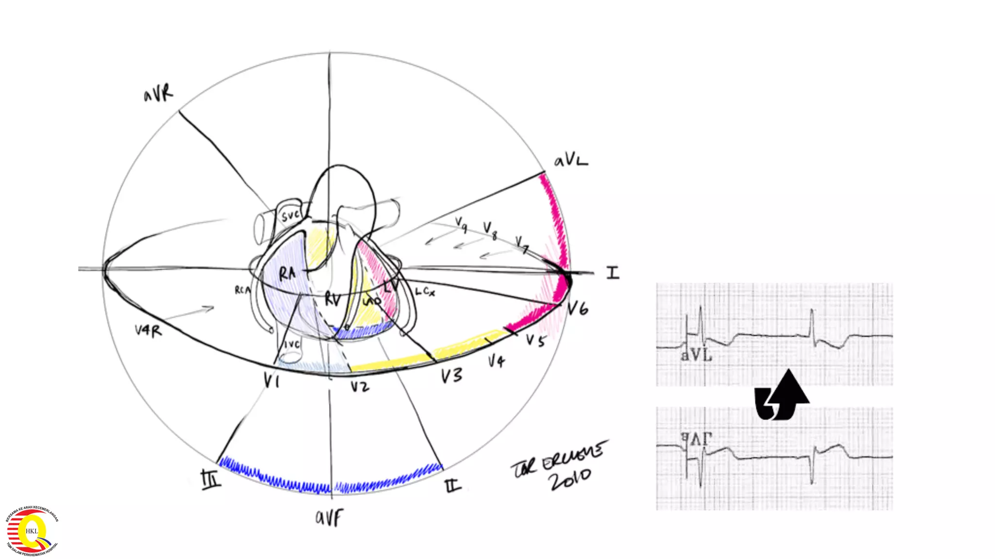 Module 5 tips and tricks- stemi ecg recognition & patterns finale | PDF