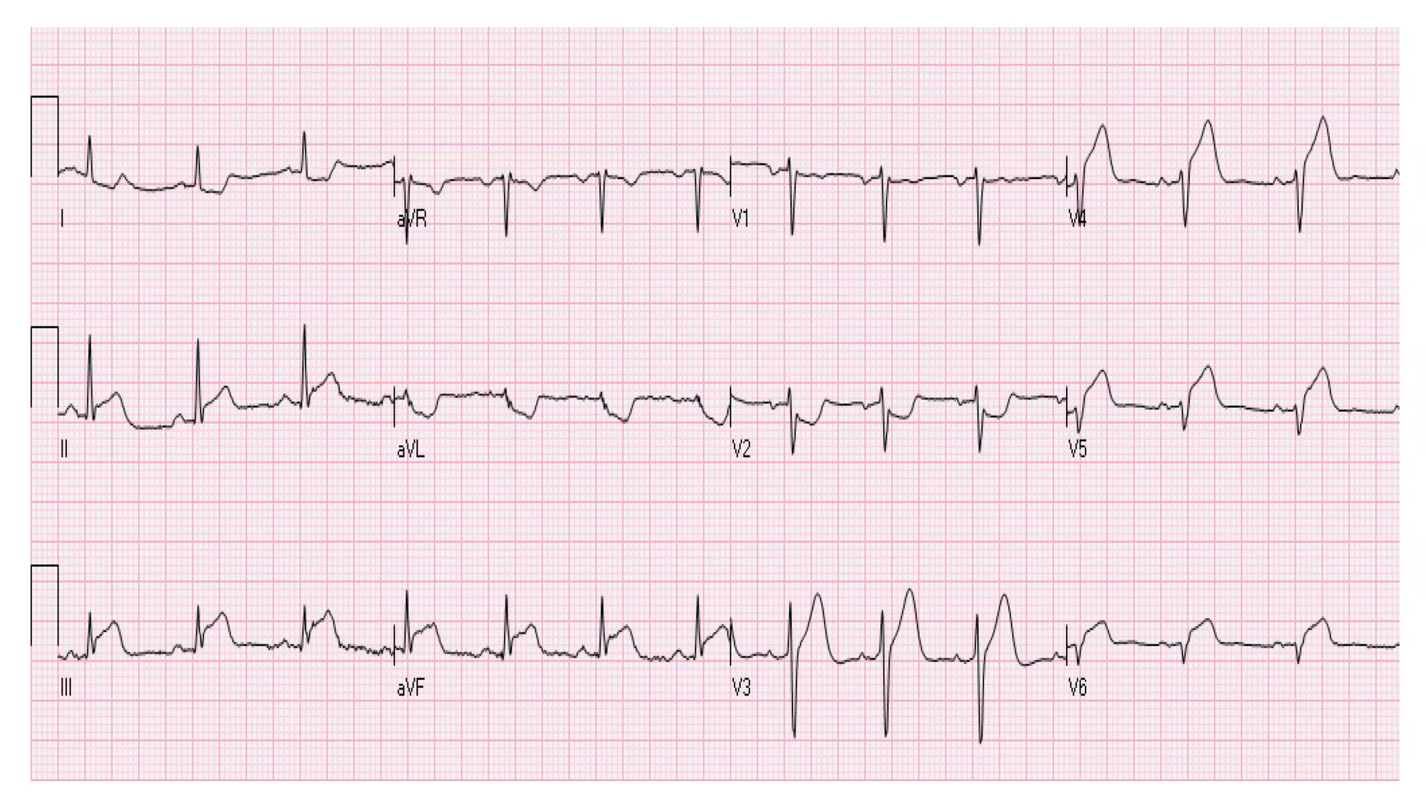 Module 5 tips and tricks- stemi ecg recognition & patterns finale | PDF