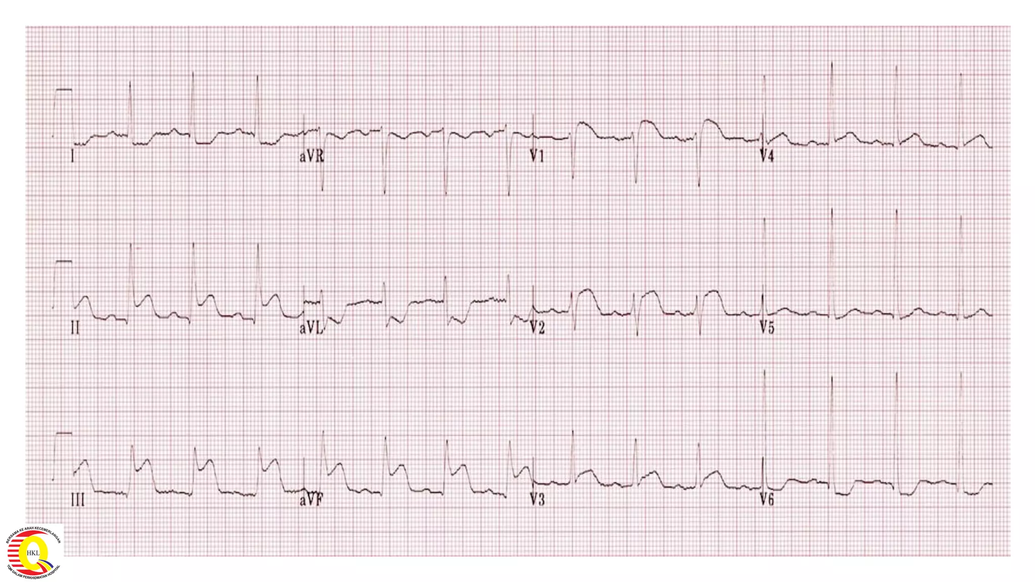 Module 5 tips and tricks- stemi ecg recognition & patterns finale | PDF