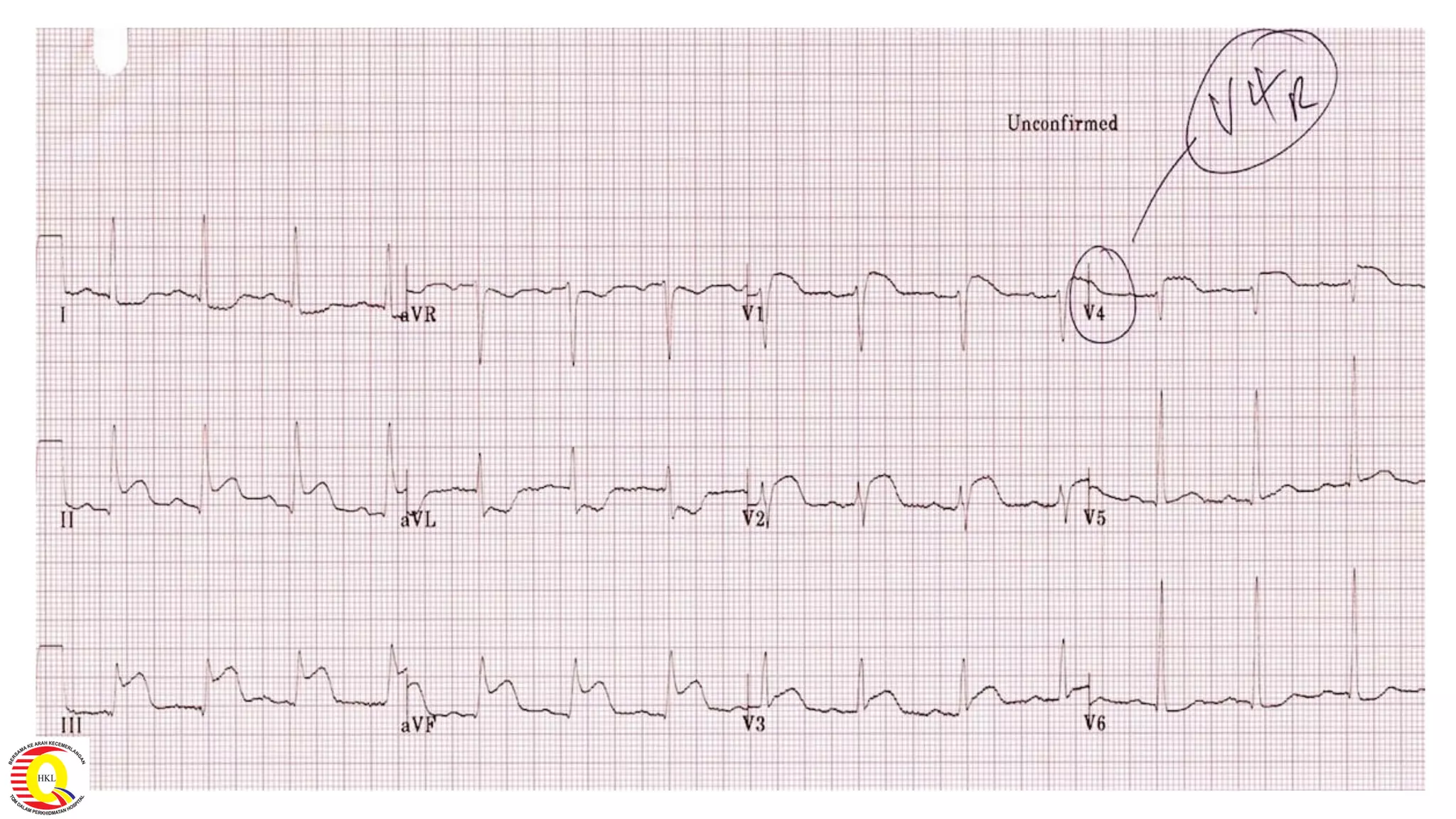 Module 5 tips and tricks- stemi ecg recognition & patterns finale | PDF