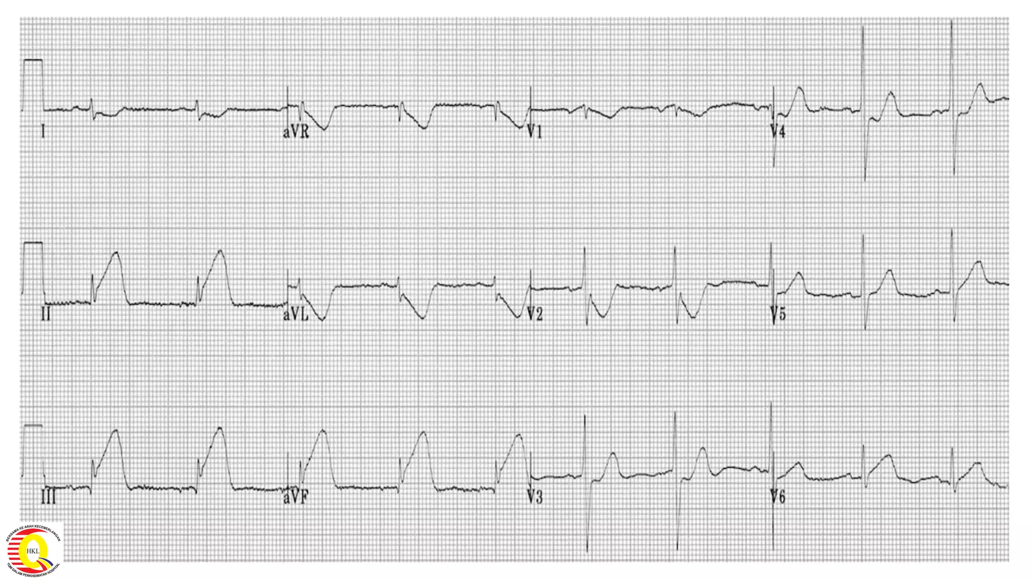Module 5 tips and tricks- stemi ecg recognition & patterns finale | PDF