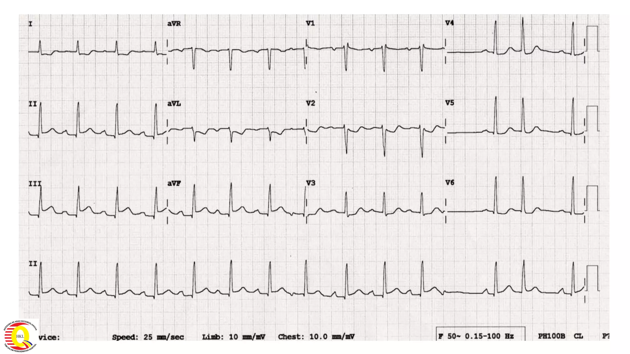 Module 5 tips and tricks- stemi ecg recognition & patterns finale | PDF