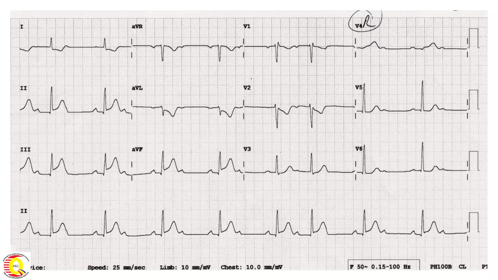 Module 5 tips and tricks- stemi ecg recognition & patterns finale | PDF