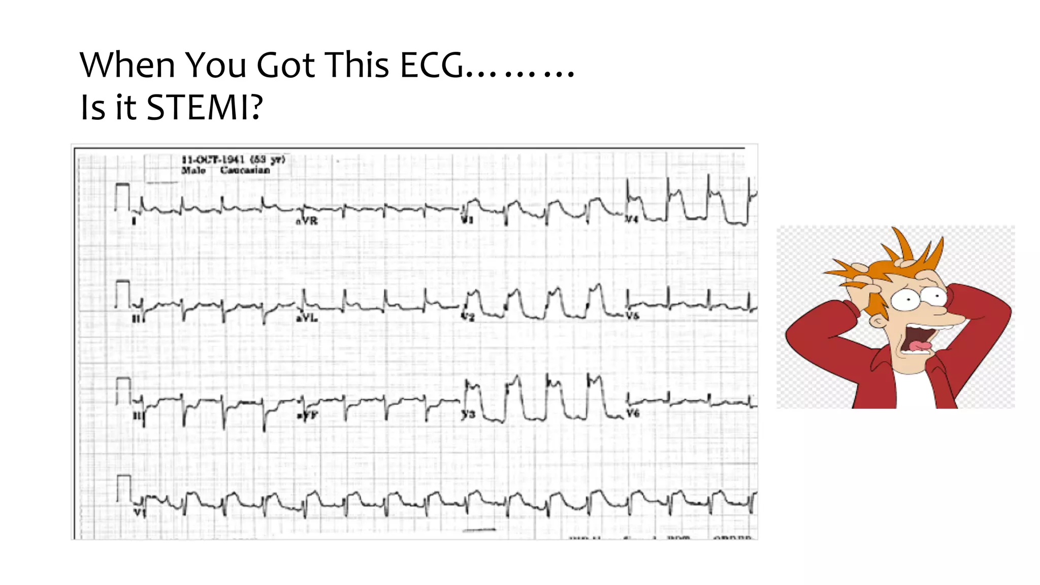 Module 5 tips and tricks- stemi ecg recognition & patterns finale | PDF