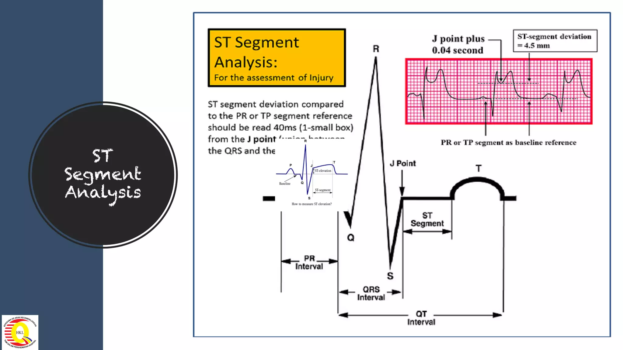 Module 5 tips and tricks- stemi ecg recognition & patterns finale | PDF