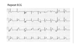 Module 5 tips and tricks- stemi ecg recognition & patterns finale | PDF