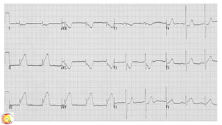 Module 5 tips and tricks- stemi ecg recognition & patterns finale | PDF