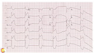 Module 5 tips and tricks- stemi ecg recognition & patterns finale | PDF
