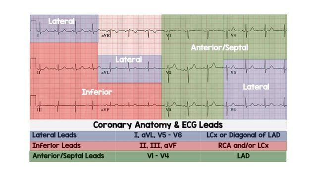 Module 5 tips and tricks- stemi ecg recognition & patterns finale | PPT