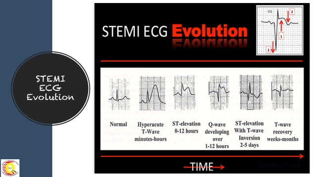 Module 5 tips and tricks- stemi ecg recognition & patterns finale | PPT