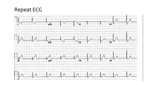 Module 5 tips and tricks- stemi ecg recognition & patterns finale | PPT