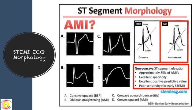 Module 5 tips and tricks- stemi ecg recognition & patterns finale | PPT